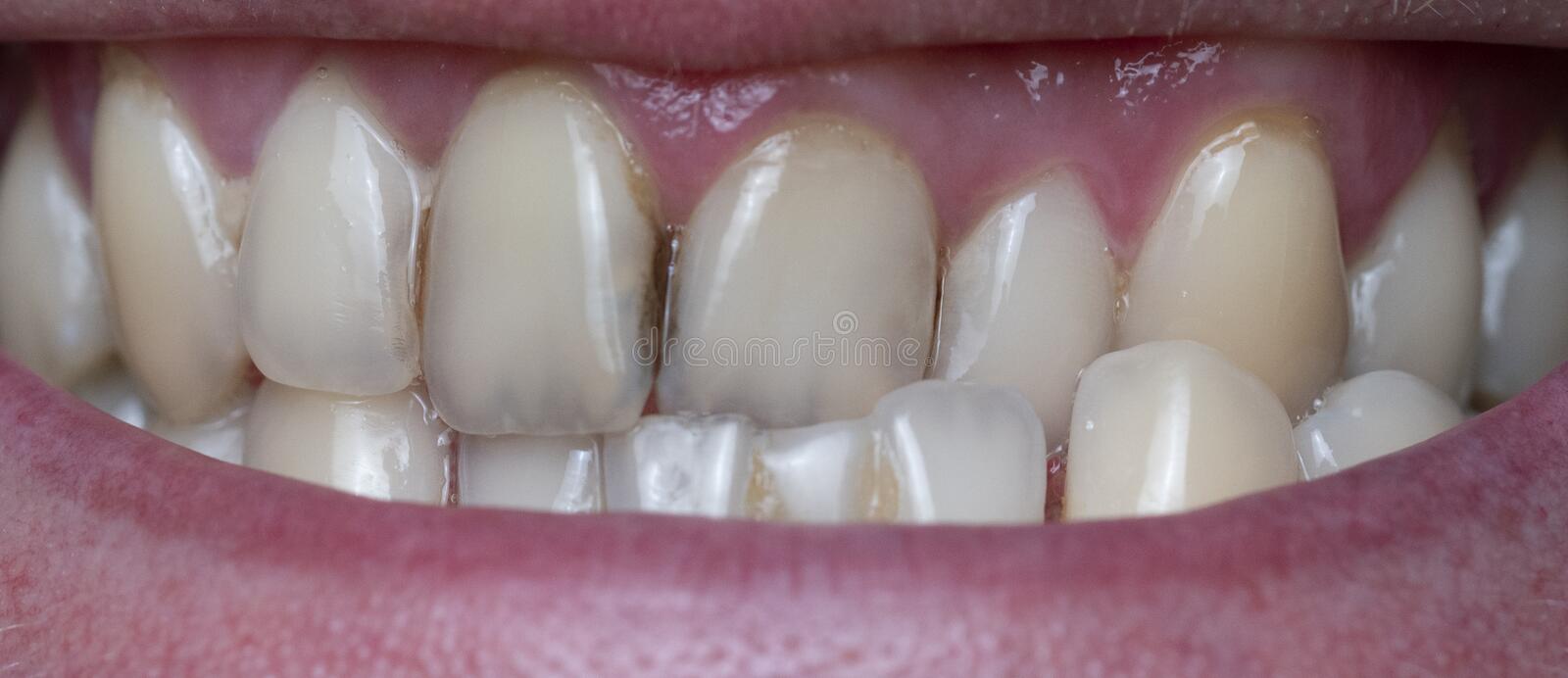 Dental Plaque Therapy - Tooth Essentials